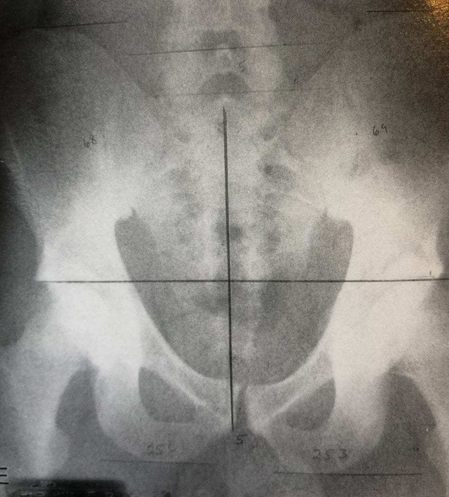 Skolios behandling | Behandla din skolios» Naprapatlandslaget